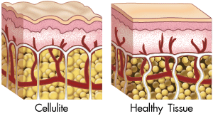 Cellulite Removal Cream | Skin Tightening Cream